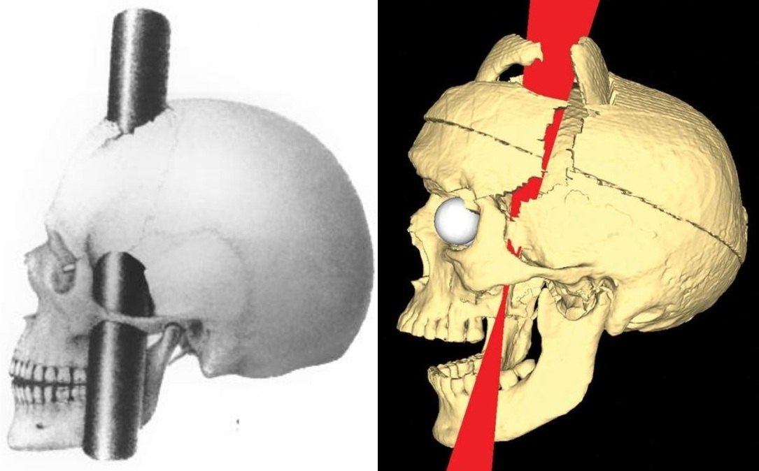 Phineas Gage, una barra de acero le atravesó el cráneo y sobrevivió ...